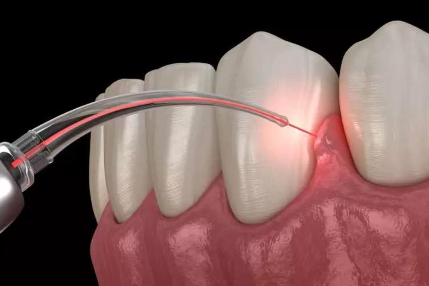 Cosmetic Gum Surgery